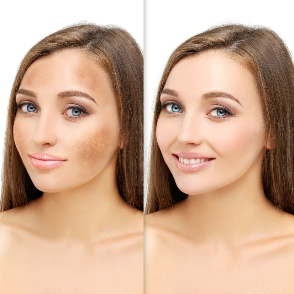 Your Guide to the Best Complexion Blending Treatment for Melasma ...